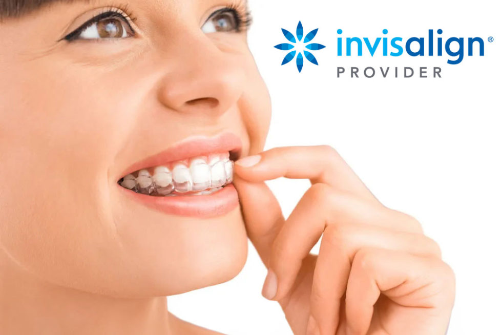 Transform Your Smile with Invisalign! Special Offer!